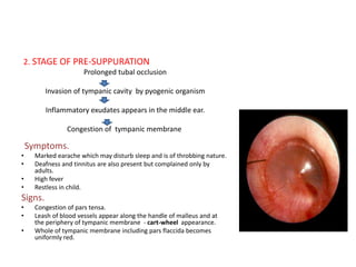 Acute otitis media | PPTX