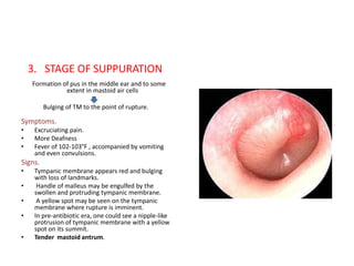 Acute otitis media | PPTX