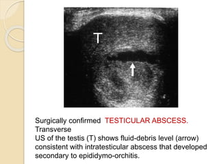 Acute painful scrotum | PPTX