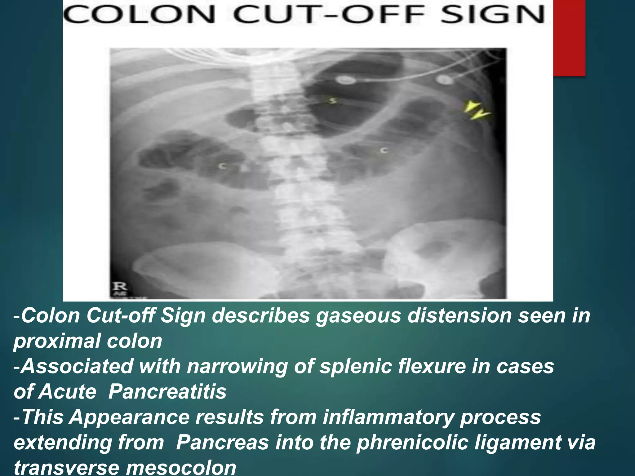 acute pancreatitis.pptx