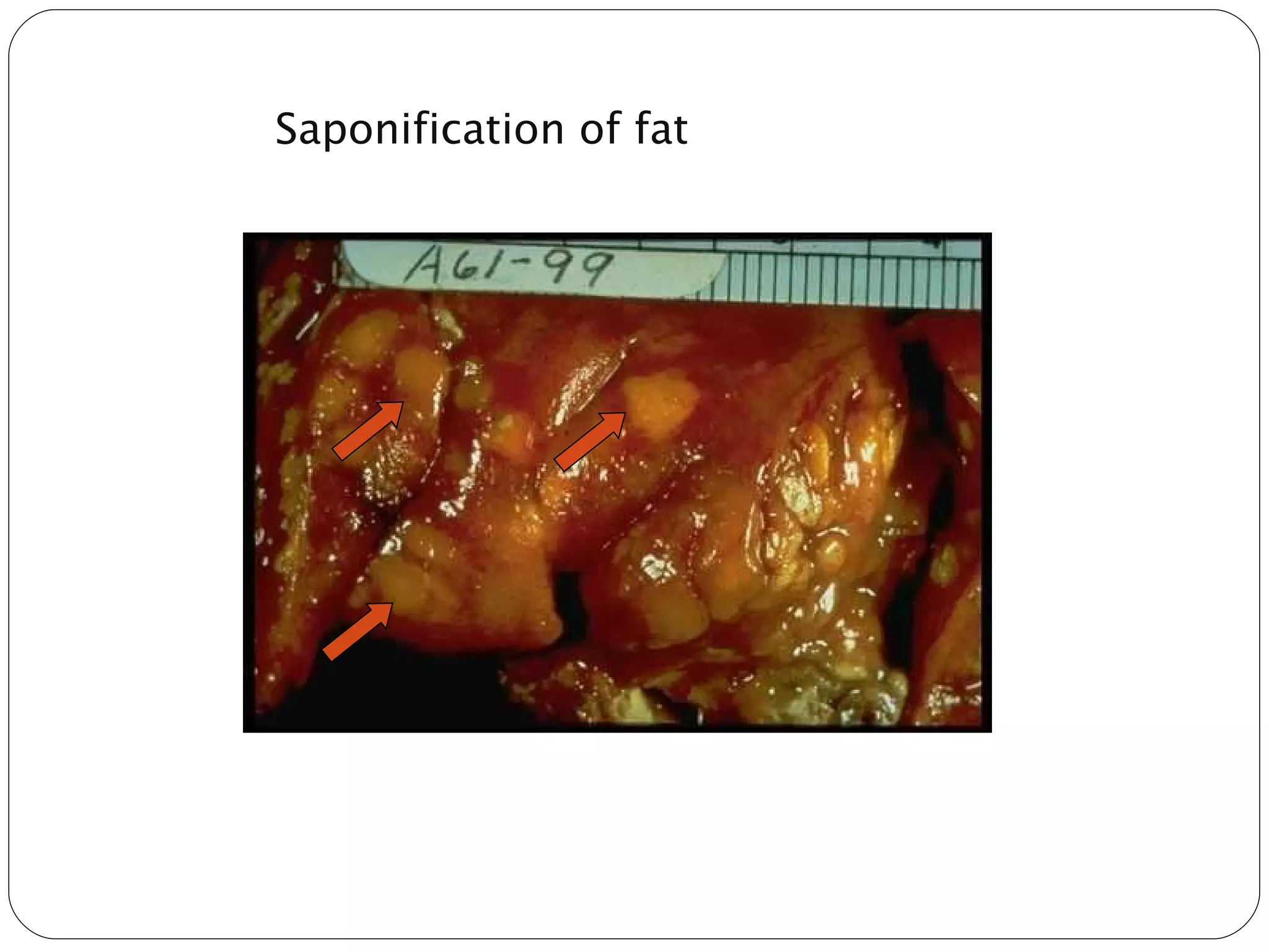 Acute Pancreatitis | PPT