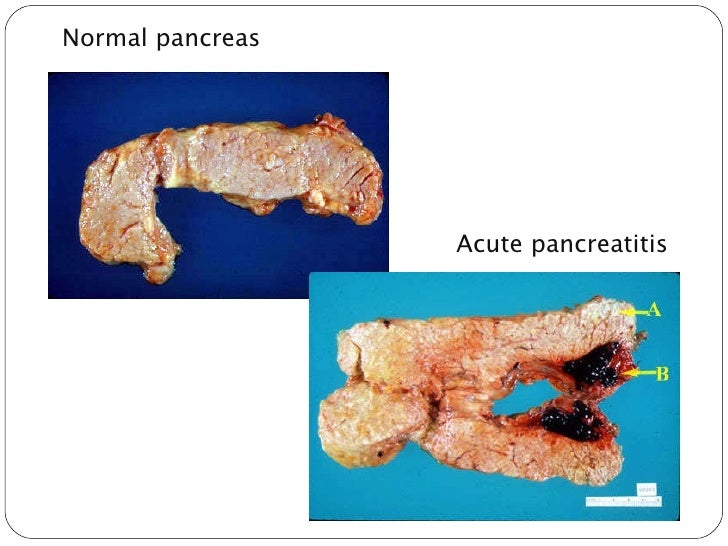 Acute Pancreatitis