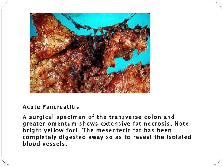 Acute Pancreatitis