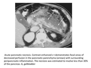 Acute pancreatitis | PPT