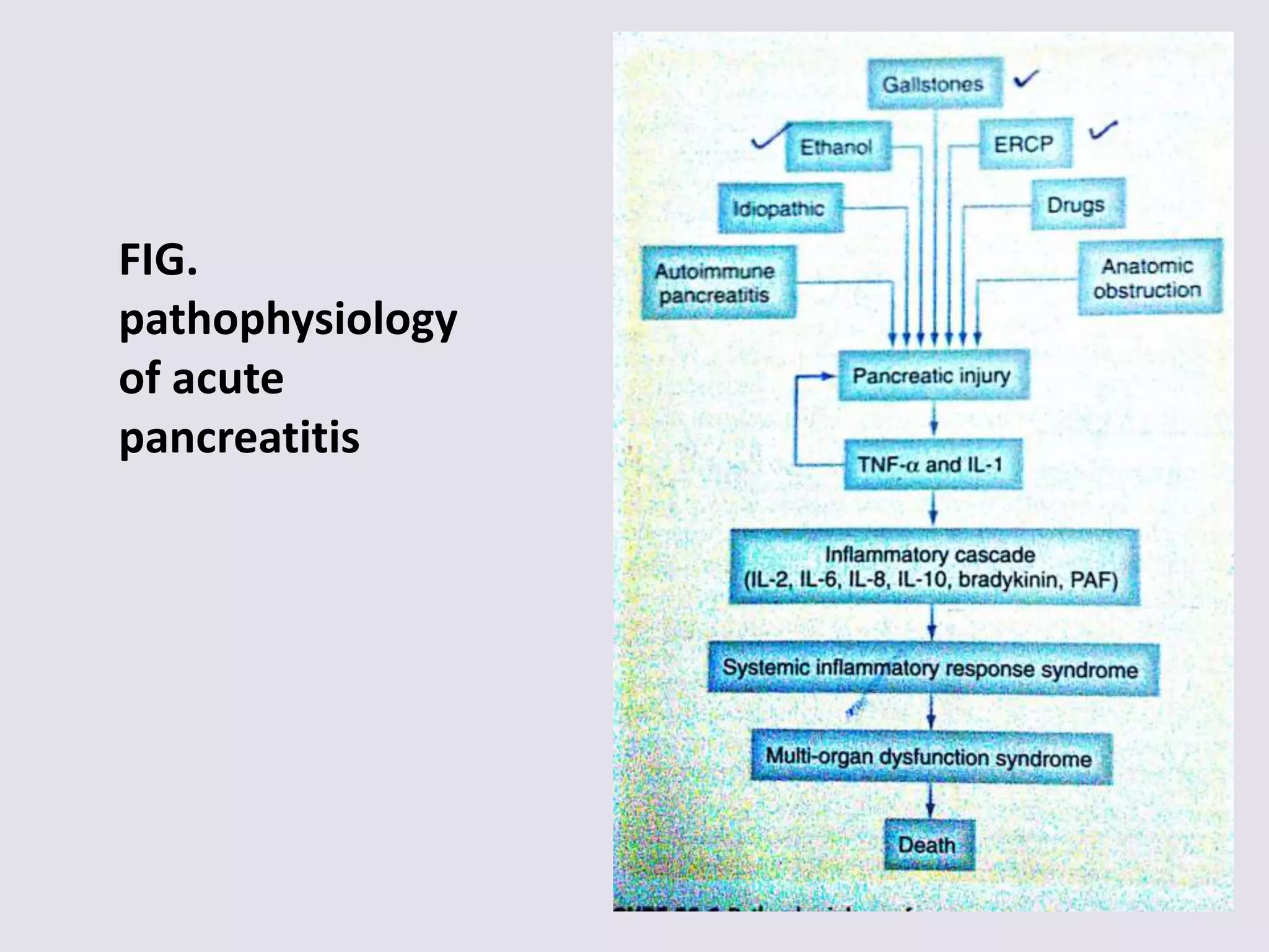 Acute pancreatitis | PPTX