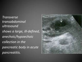 Pancreatic Abscess Ultrasound