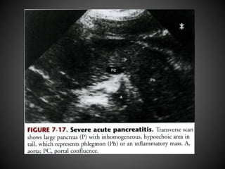 Phlegmonous Pancreatitis Ultrasound