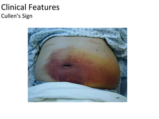 Acute Pancreatitis | PPT