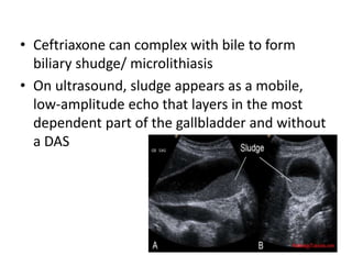 Acute pancreatitis | PPTX