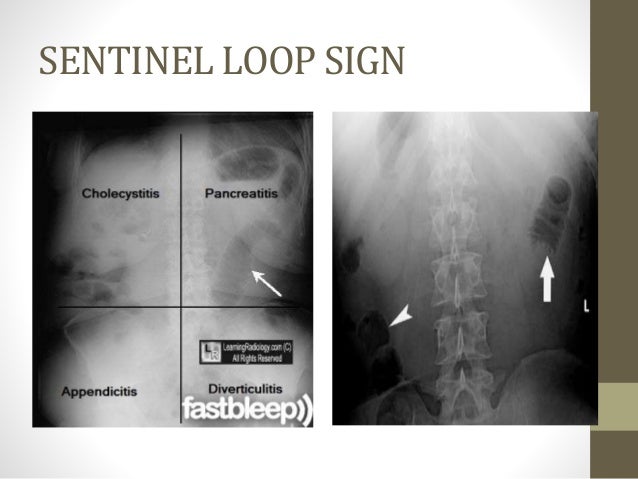 Acute pancreatitis