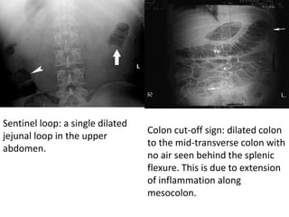 Acute pancreatitis | PPT