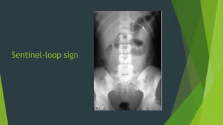 Acute pancreatitis | PPT