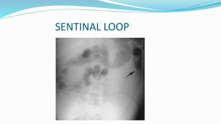 Acute pancreatitis | PPT