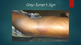 Acute pancreatitis | PPT