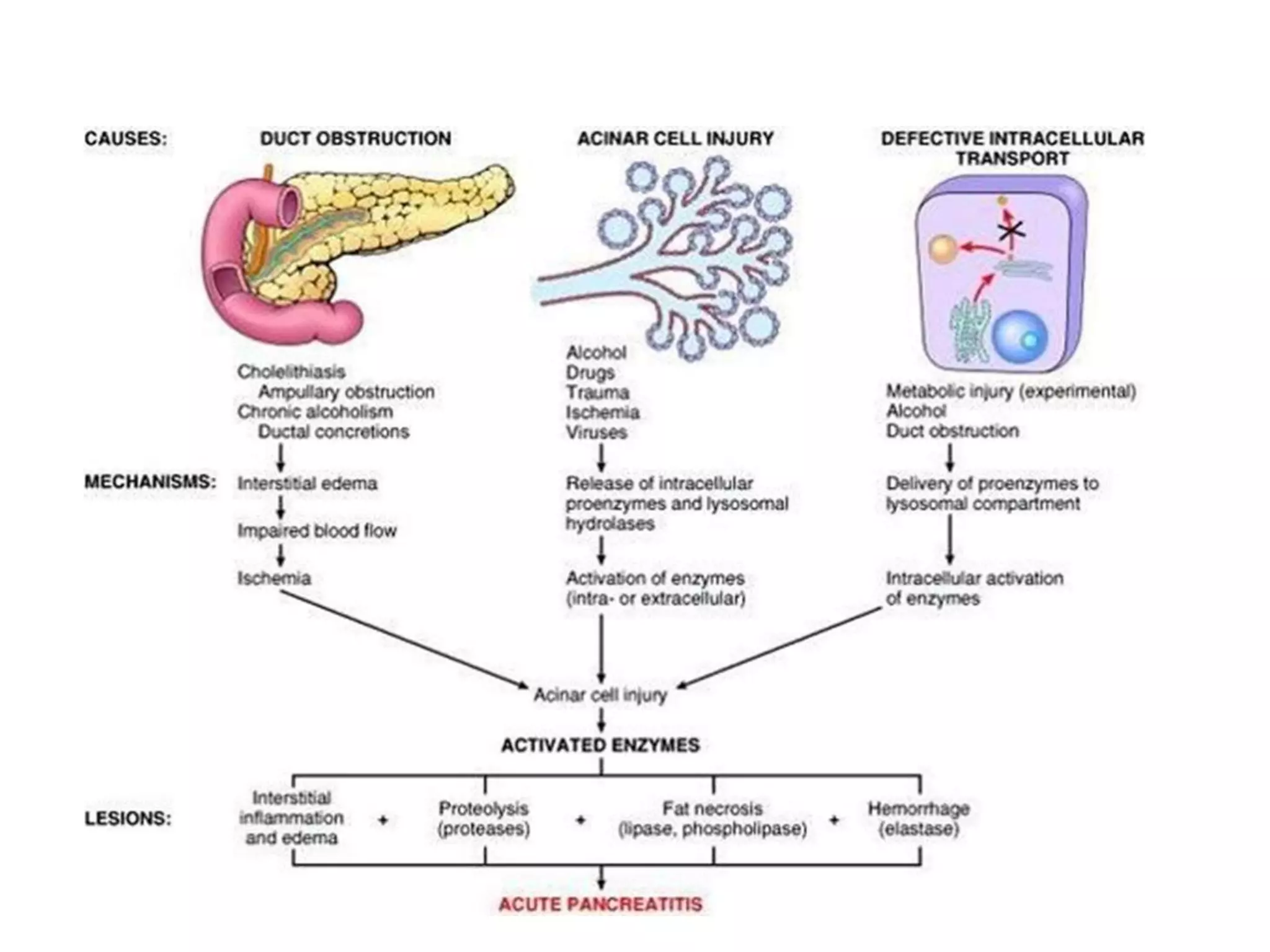 Acute pancreatitis | PPTX