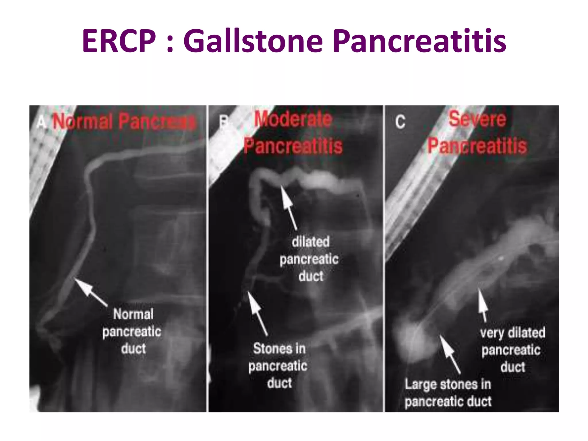 Acute pancreatitis | PPTX