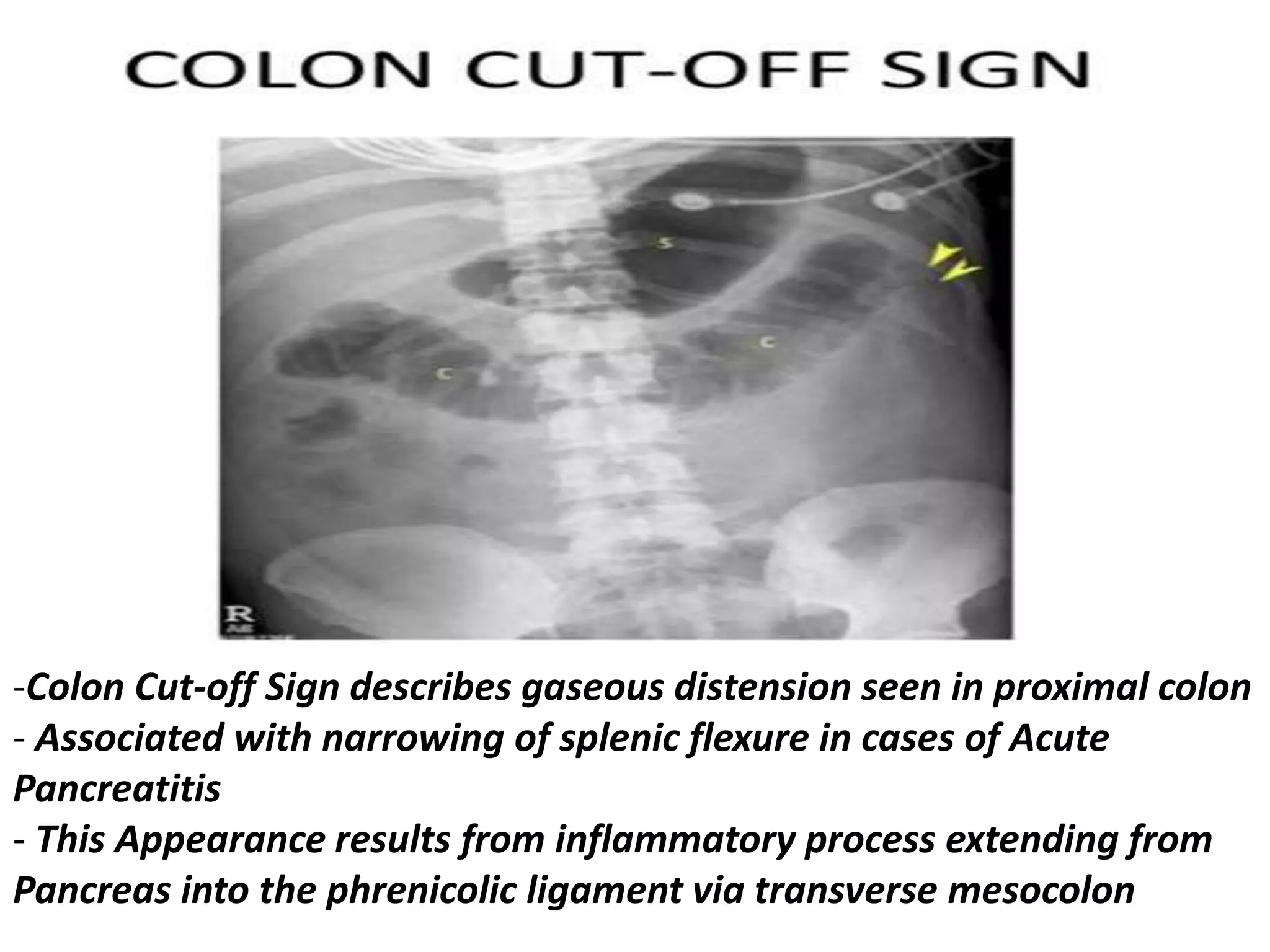 Acute pancreatitis | PPTX