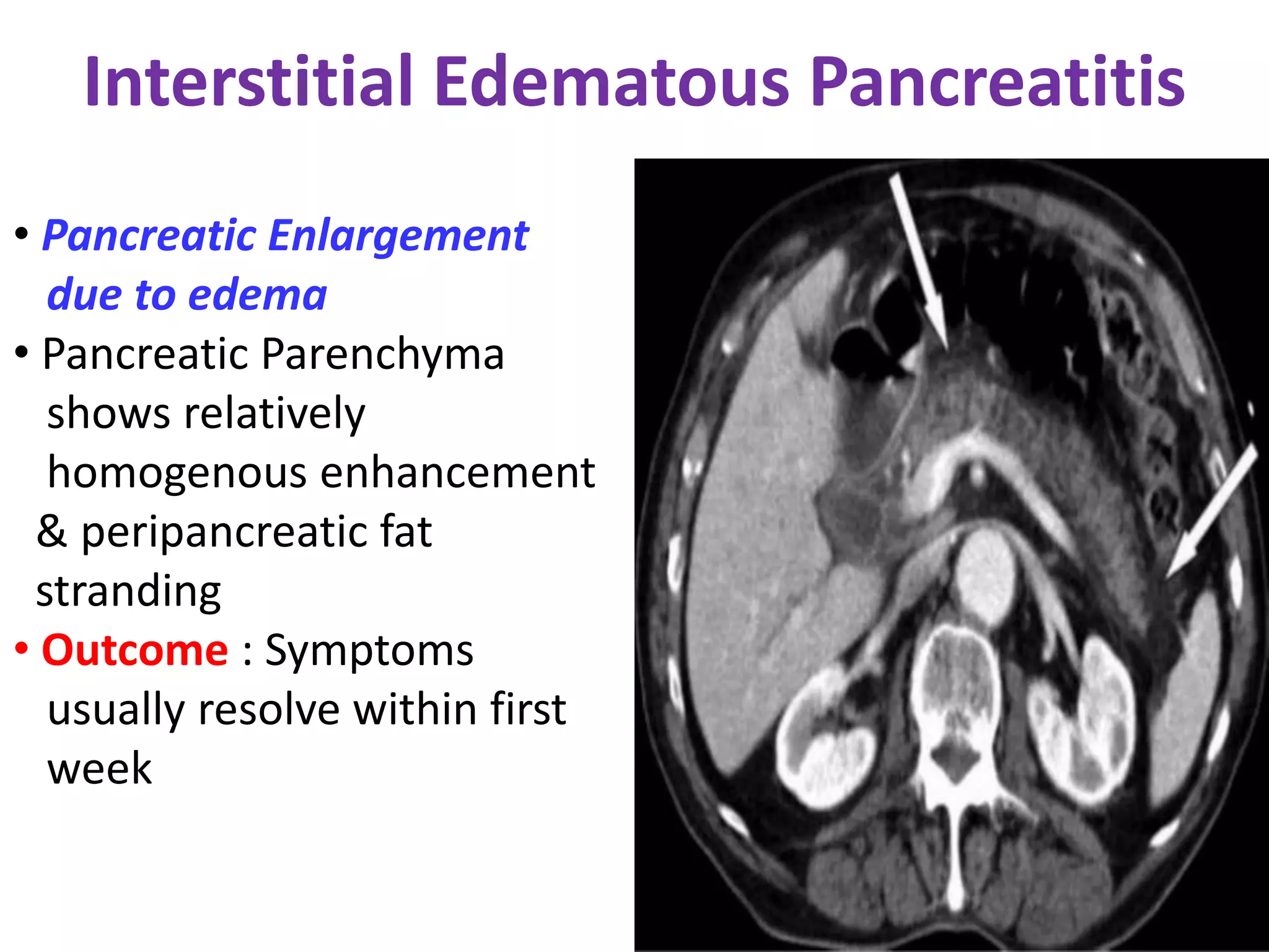 Acute pancreatitis | PPTX