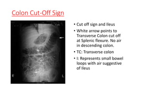 Acute pancreatitis | PPTX