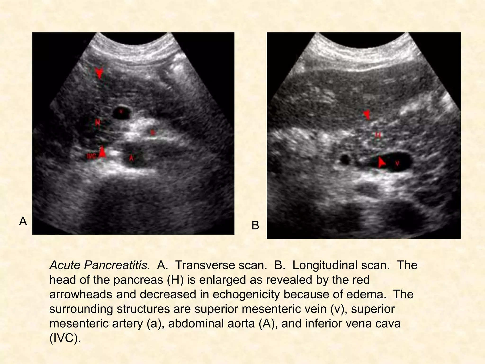 Acute Pancreatitis.ppt
