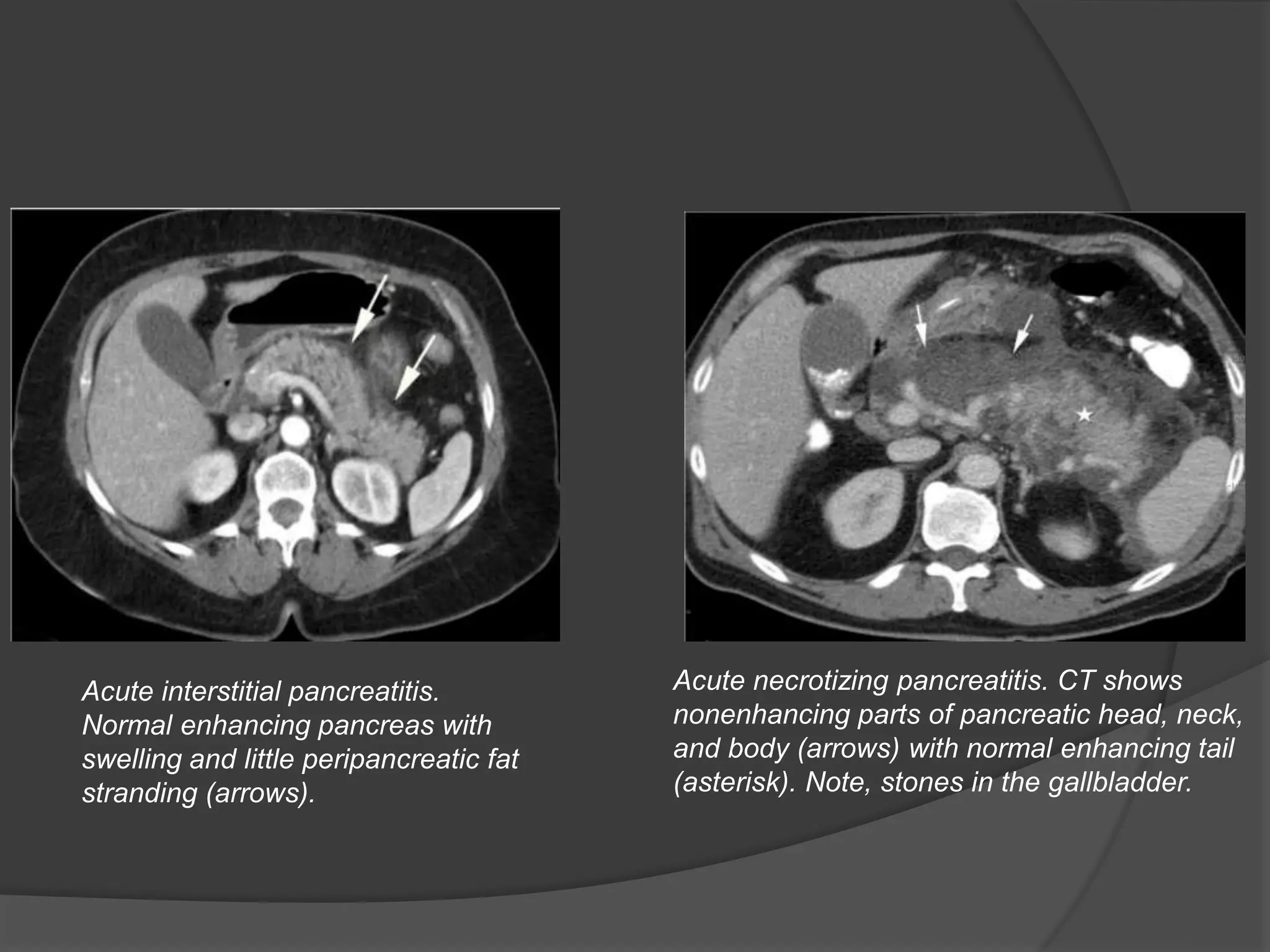 ACUTE PANCREATITIS.pptx