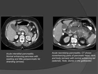 ACUTE PANCREATITIS.pptx