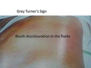 ACUTE PANCREATITIS.pptx