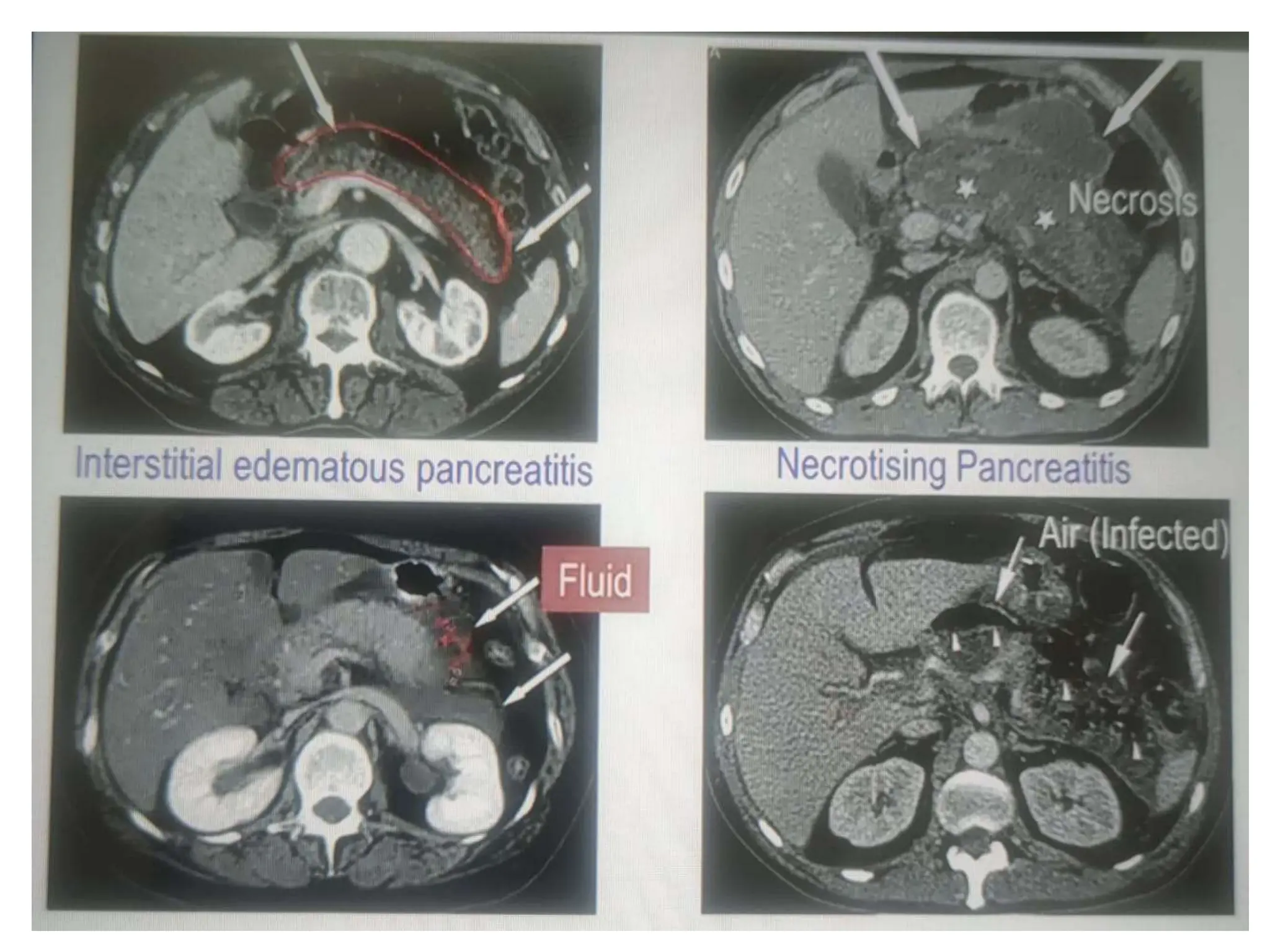 ACUTE PANCREATITIS classification & management.pptx