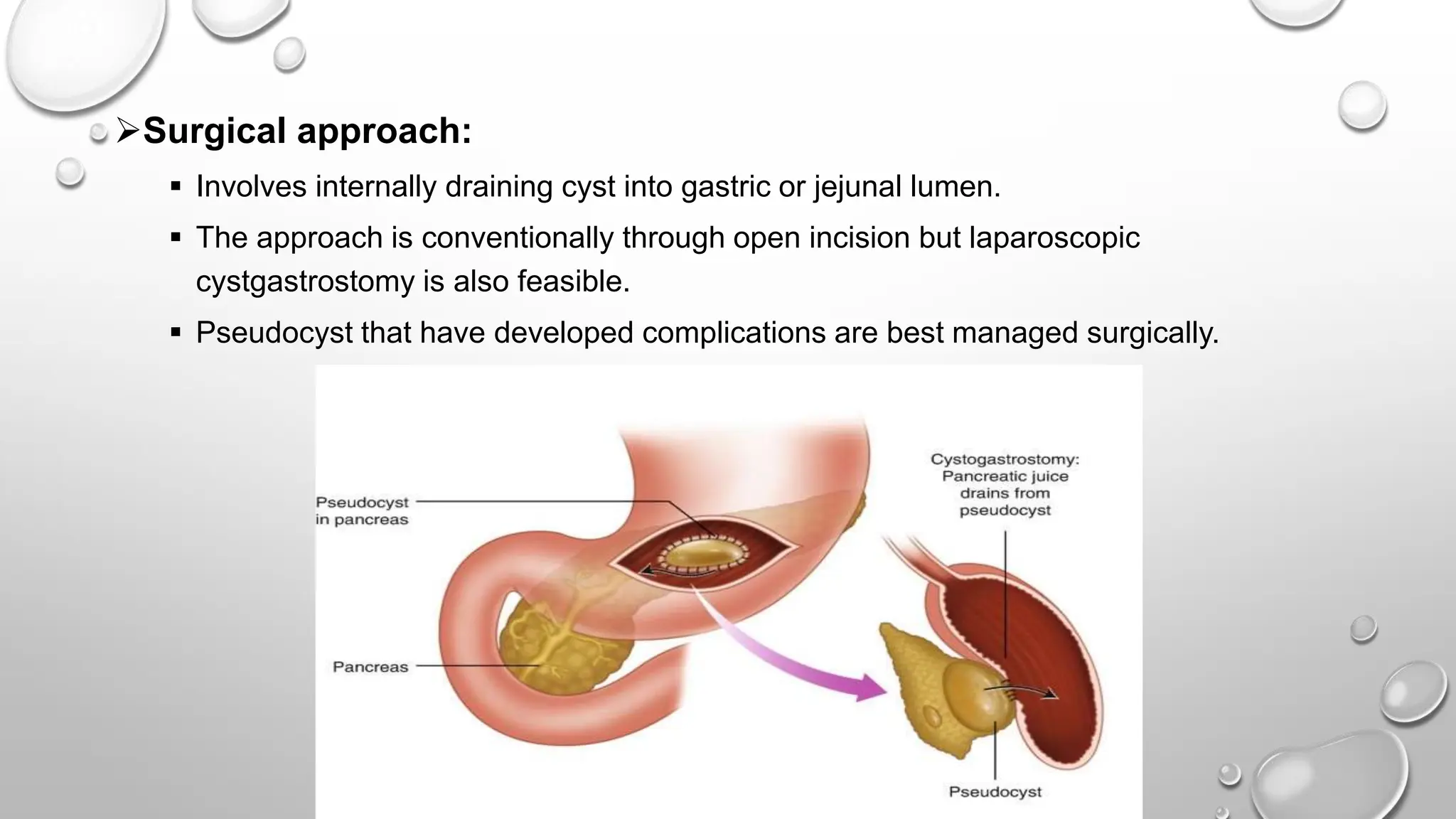 ACUTE PANCREATITIS and surgical management | PPTX