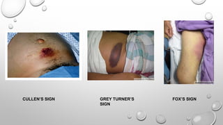 ACUTE PANCREATITIS and surgical management | PPTX