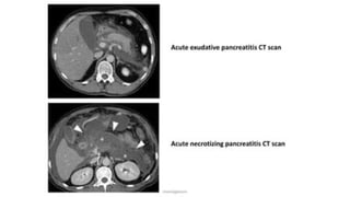 Acute pancreatitis causes and treatment. | PPTX