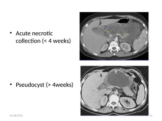 Acute pancreatitis and their management .pptx