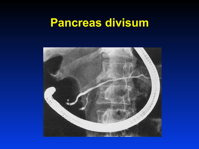 ACUTE PANCREATITIS.ppt in clinical surgery | PPT