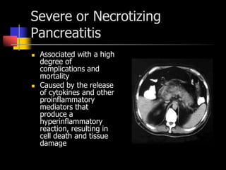 acute pancreatitis | PPT