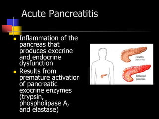 acute pancreatitis | PPT