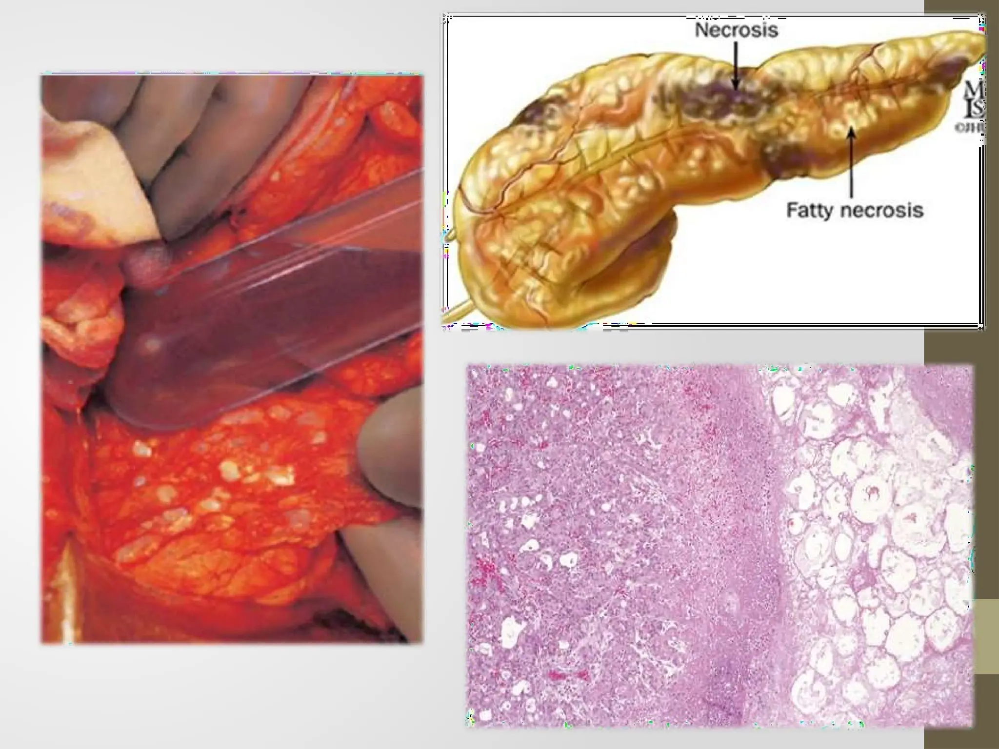 ACUTE PANCREATITIS AND GALL STONESS.pptx