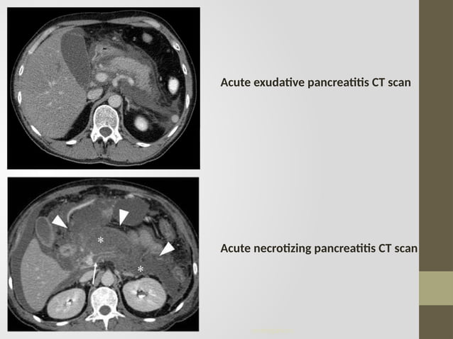 ACUTE PANCREATITIS AND GALL STONESS.pptx