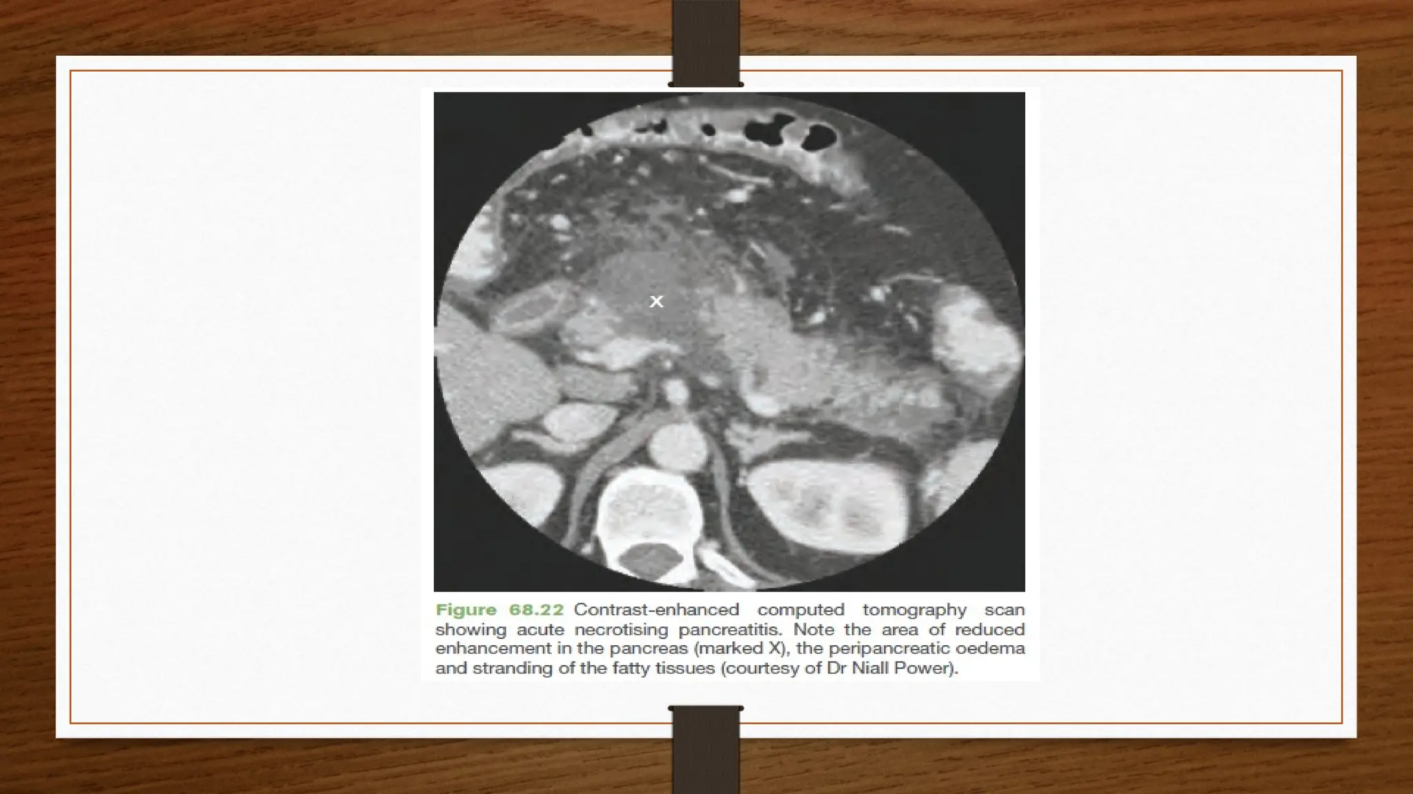 Acute pancreatitis [Autosaved].pptx surgery | PPT