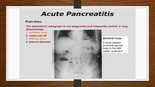 Acute pancreatitis [Autosaved].pptx surgery | PPT