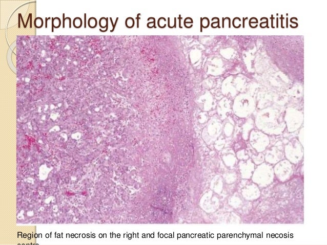 Acute pancreatitis ca pancreas naulo_lmc