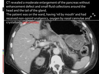 Acute pancreatitis case discussion | PPSX