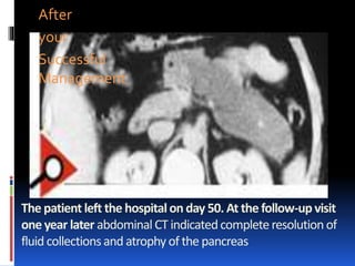 Acute pancreatitis case discussion | PPSX