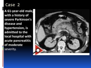 Acute pancreatitis case discussion | PPSX