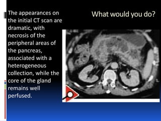 Acute pancreatitis case discussion | PPSX