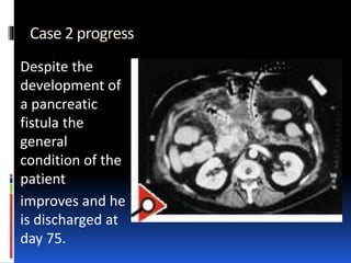 Acute pancreatitis case discussion | PPSX