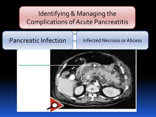 Acute pancreatitis case discussion | PPSX