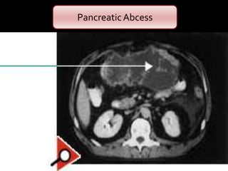 Acute pancreatitis case discussion | PPSX