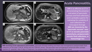 acute pancreatitis Dr Maha Hafez 2020.pdf
