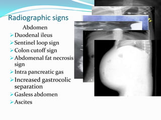 Acute pancreatitis radiological approach | PPTX