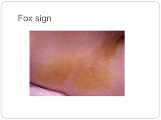 Fox Sign Pancreatitis